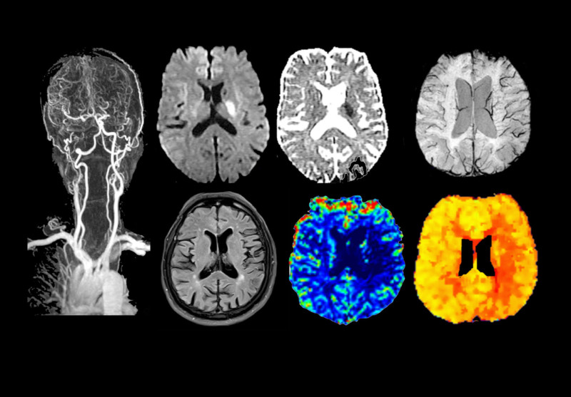 Multiparametric MRI - CSI