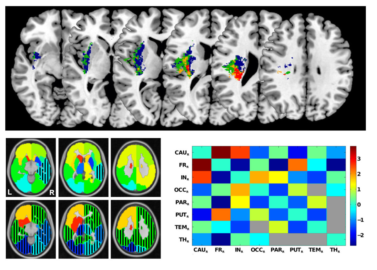 Multivariate lesion symptom mapping - CSI